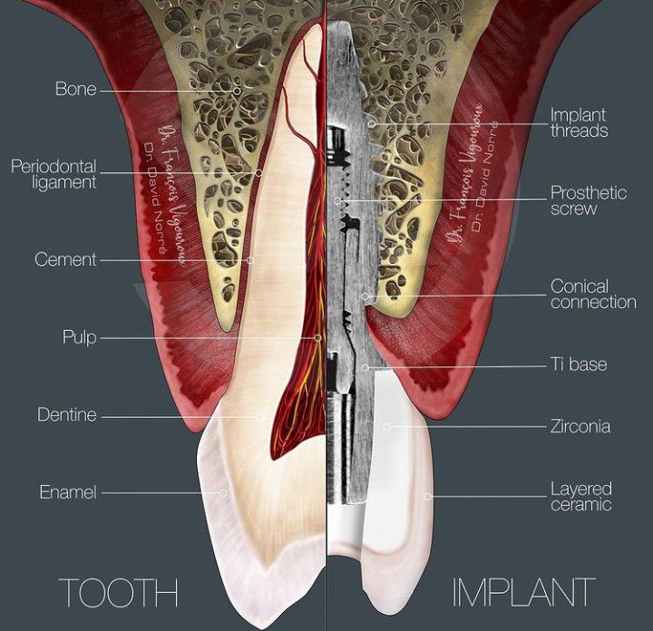 Tooth Implant - MEDizzy