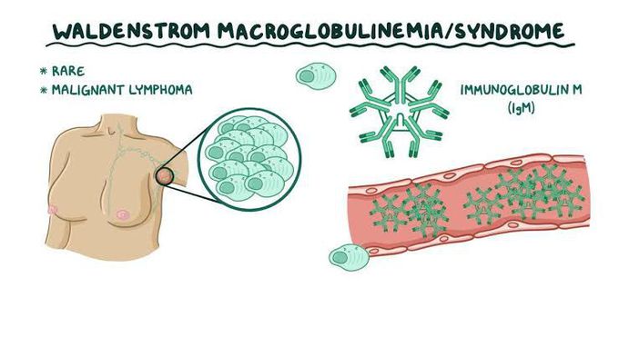 Waldenstorm Macroglobulinemia - MEDizzy