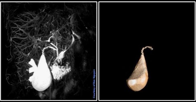 MRCP “PEAR” @ Siemens 1.5T Aera Somehow it looks like a - MEDizzy