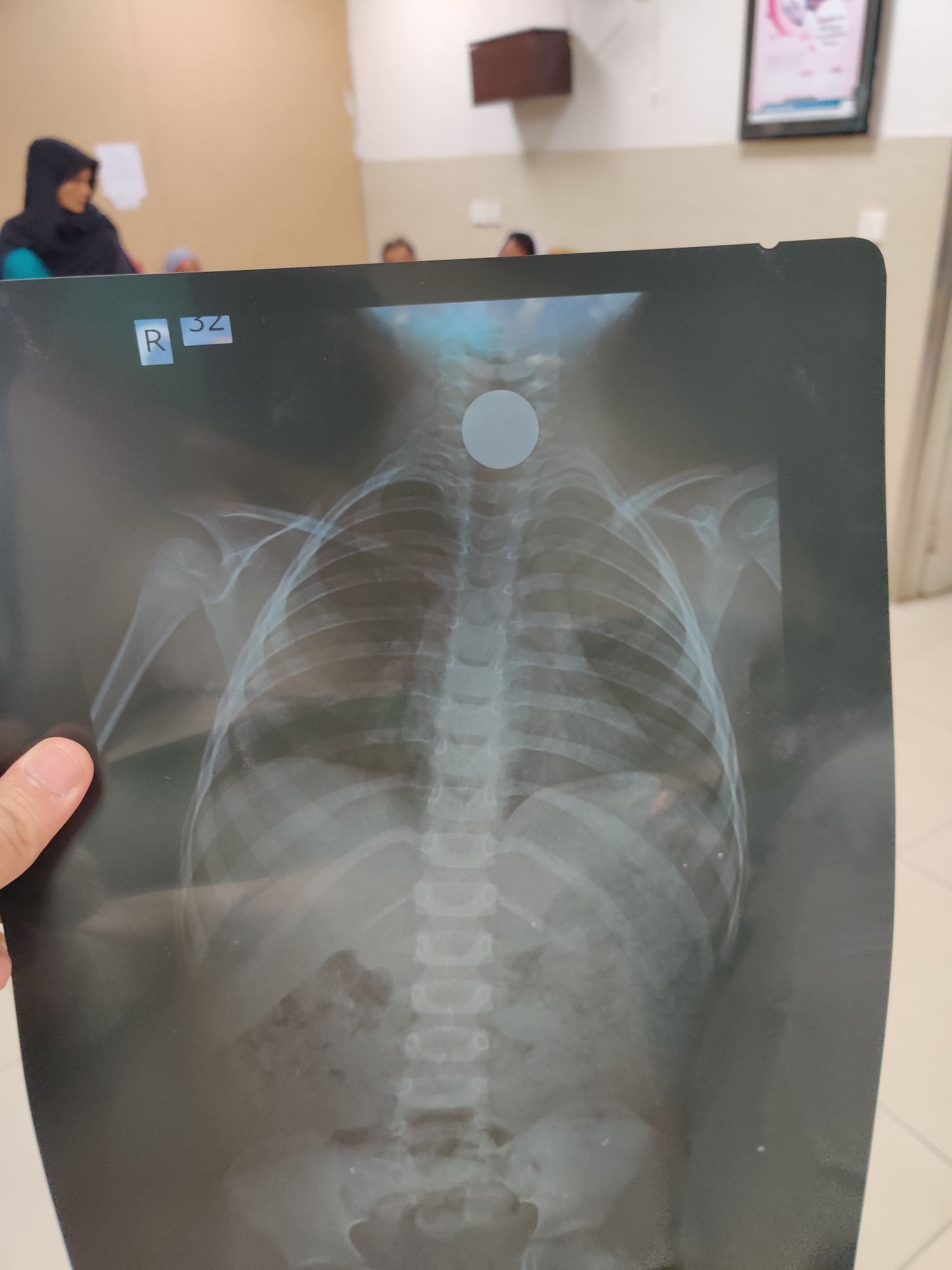 Coin ingestion - MEDizzy