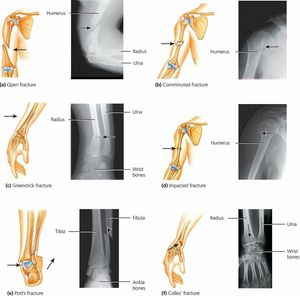 Types of fractures - MEDizzy