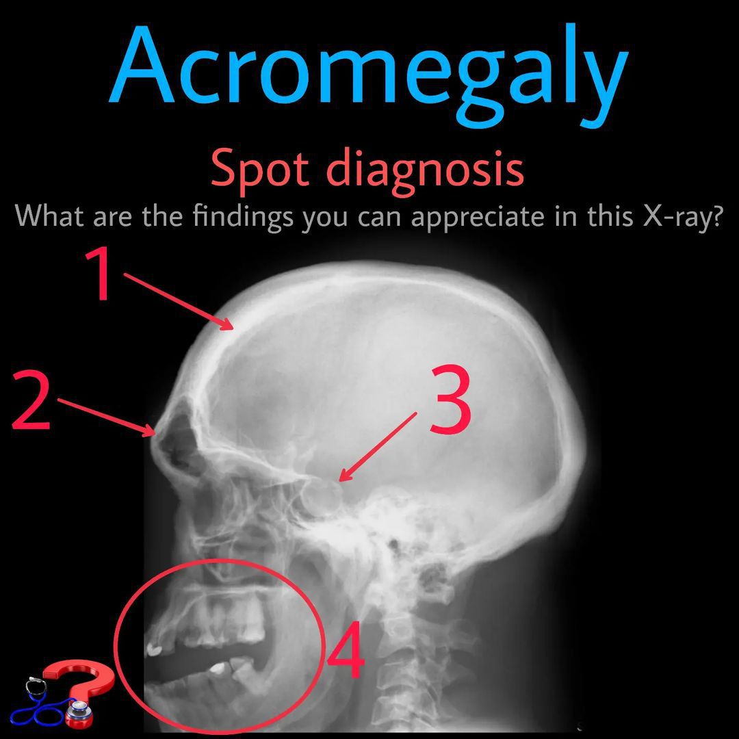acromegaly teeth gap