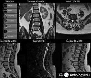 Lumbar MRI - MEDizzy