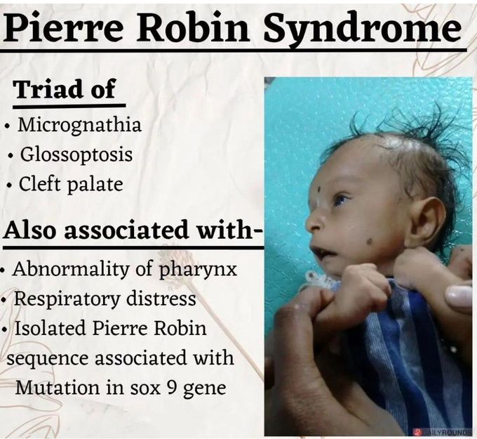 Pierre Robin Syndrome MEDizzy