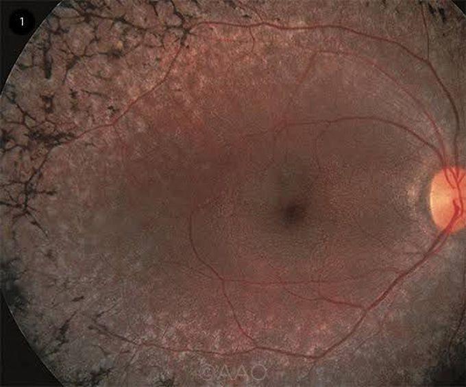 Retinitis pigmentosa - MEDizzy