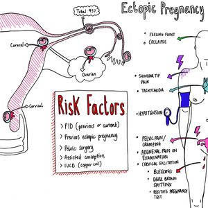 Ectopic Pregnancy - MEDizzy
