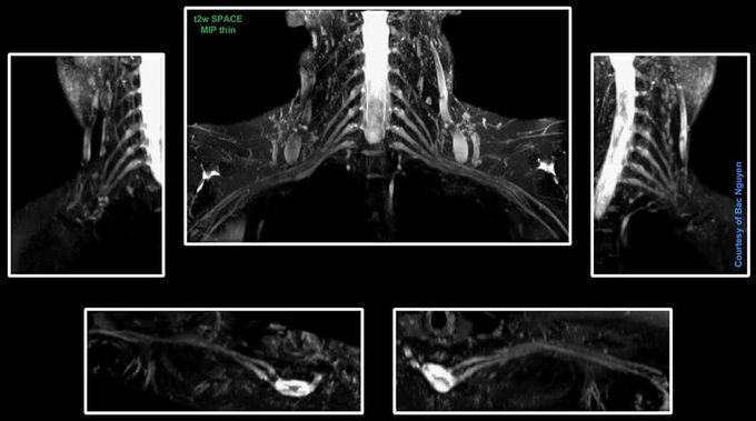 Brachial Plexus @ Siemens 3T Skyra It’s amazing how much - MEDizzy