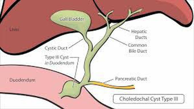 Choledochal cyst - MEDizzy