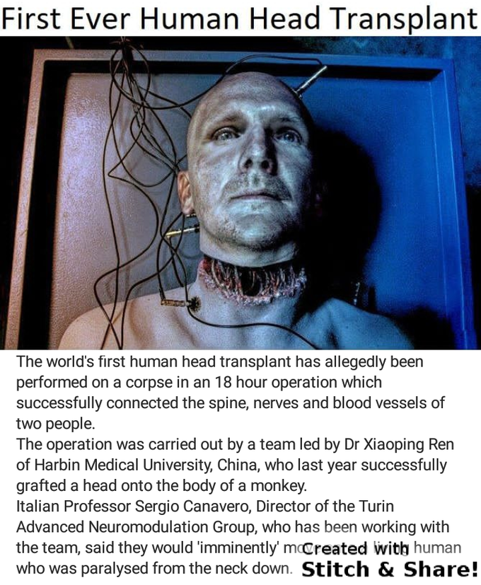 The first ever human head transplant - MEDizzy