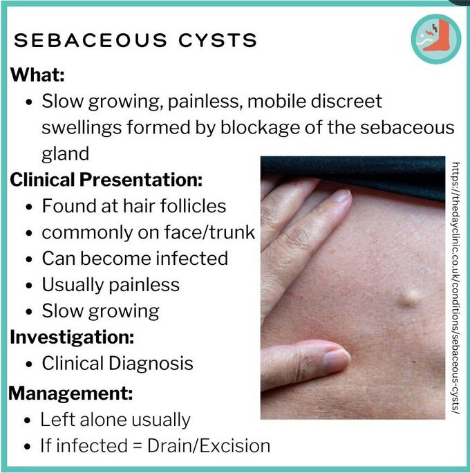 Sebaceous Cyst - MEDizzy