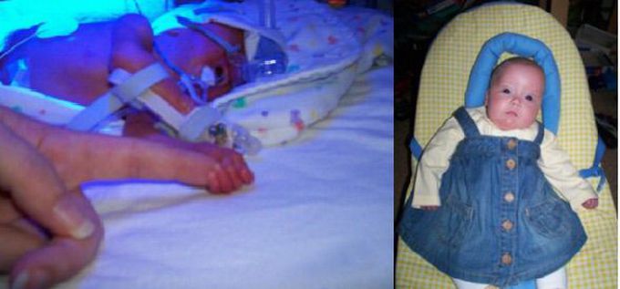 Premature Baby then and now. - MEDizzy