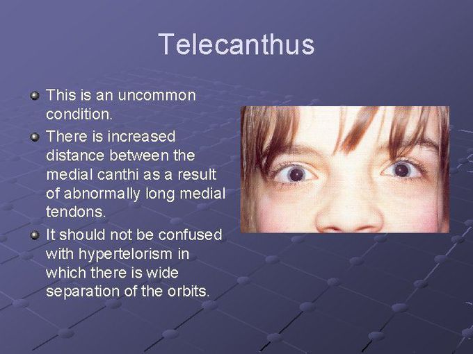 Telancanthus - MEDizzy