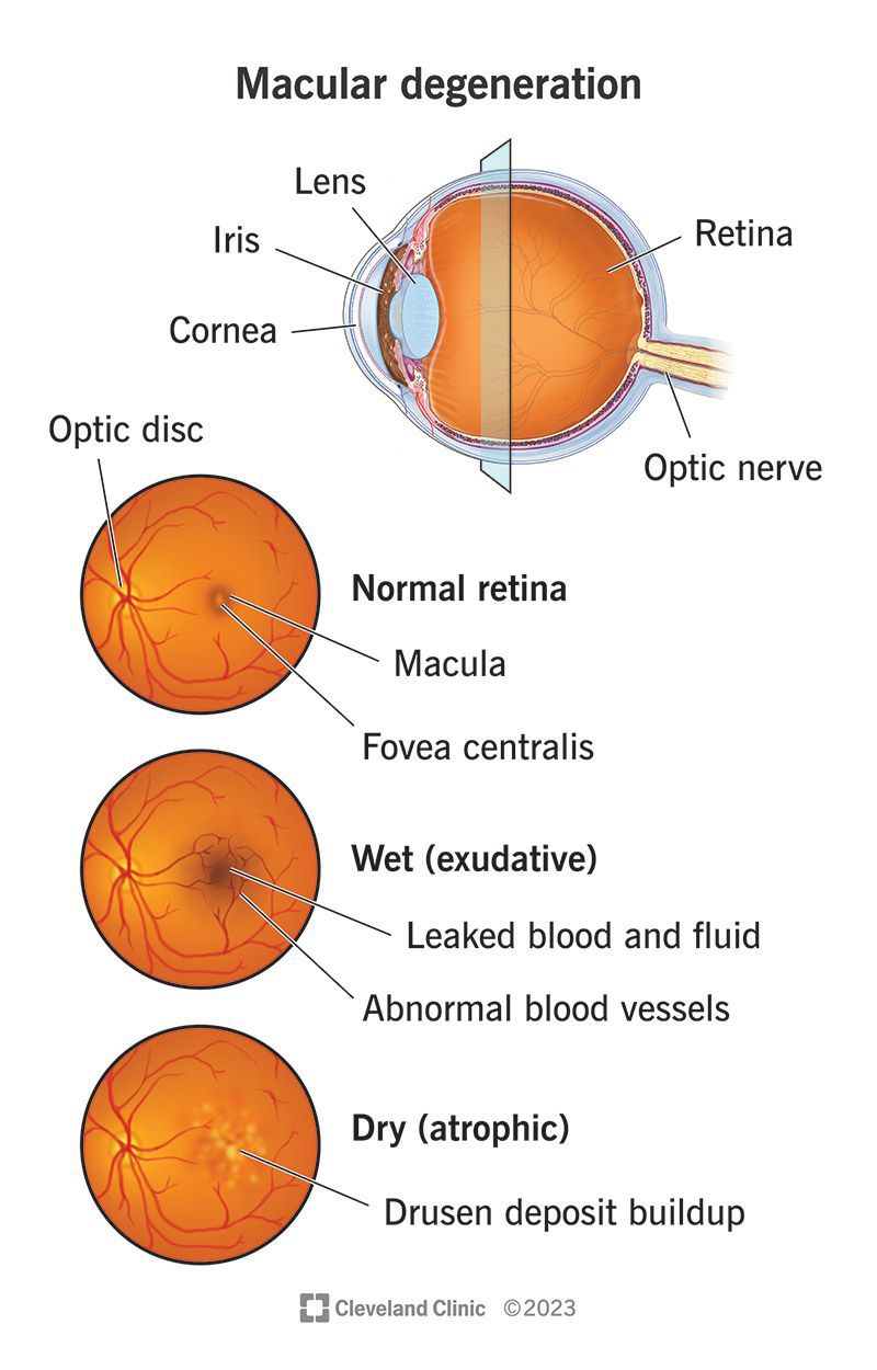 What Are The Symptoms Of Macular Degeneration MEDizzy