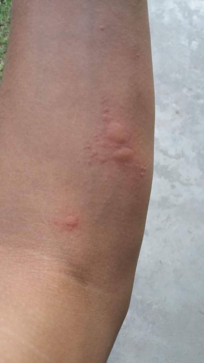 Skin Lesion - MEDizzy