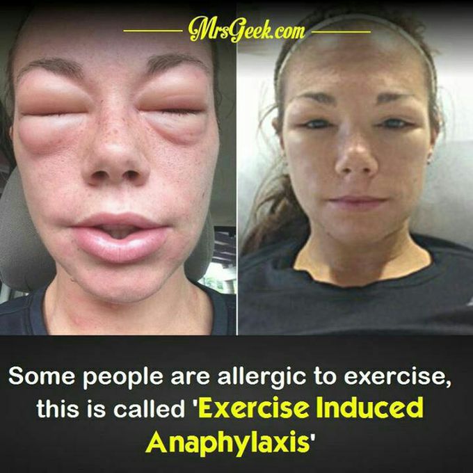Exercise induced anaphylaxis - MEDizzy