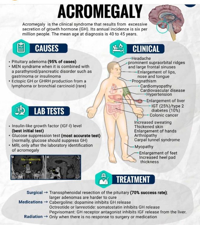 Acromegaly - MEDizzy