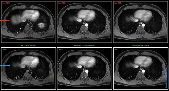 Useful abdominal dynamic tips for MRI Siemens users Liver - MEDizzy