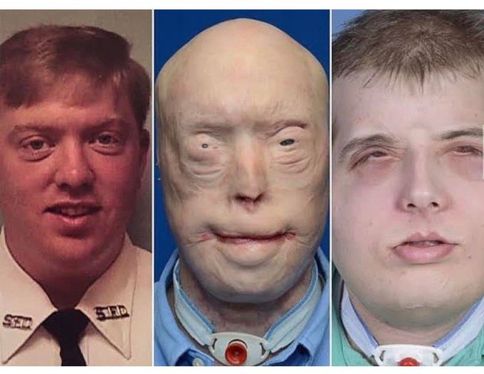Face Transplant Surgery - MEDizzy