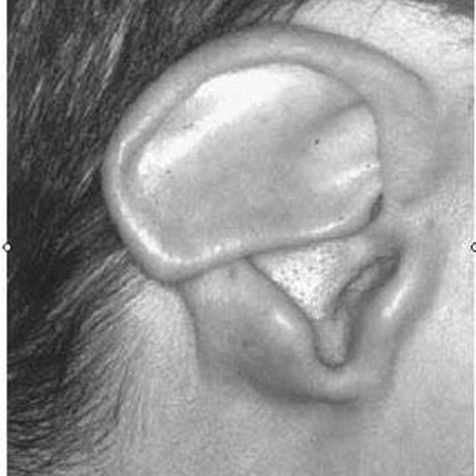 Coloboma ear - MEDizzy