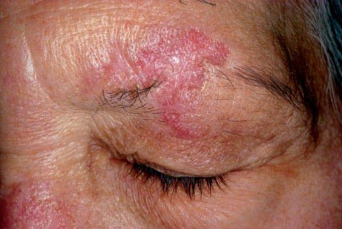 Discoid lupus erythmatosus - MEDizzy
