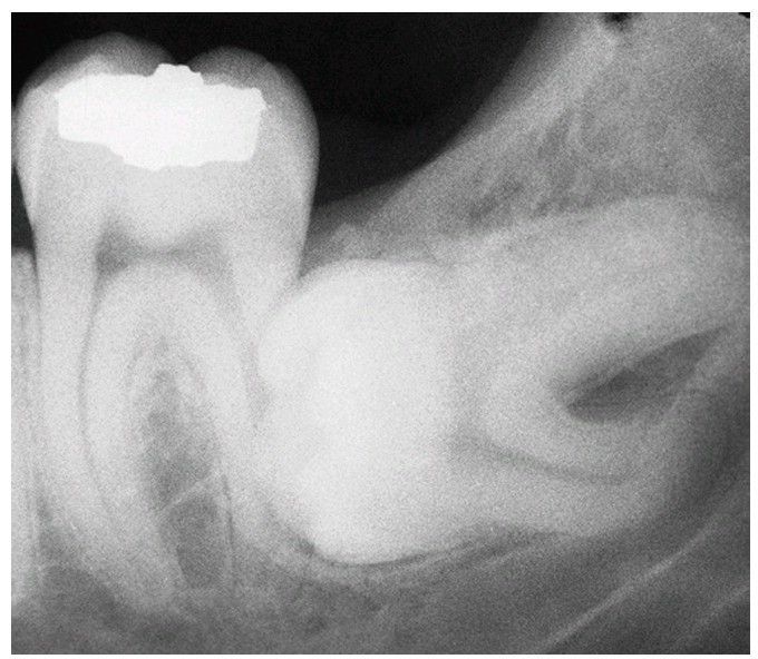 Impacted tooth - MEDizzy