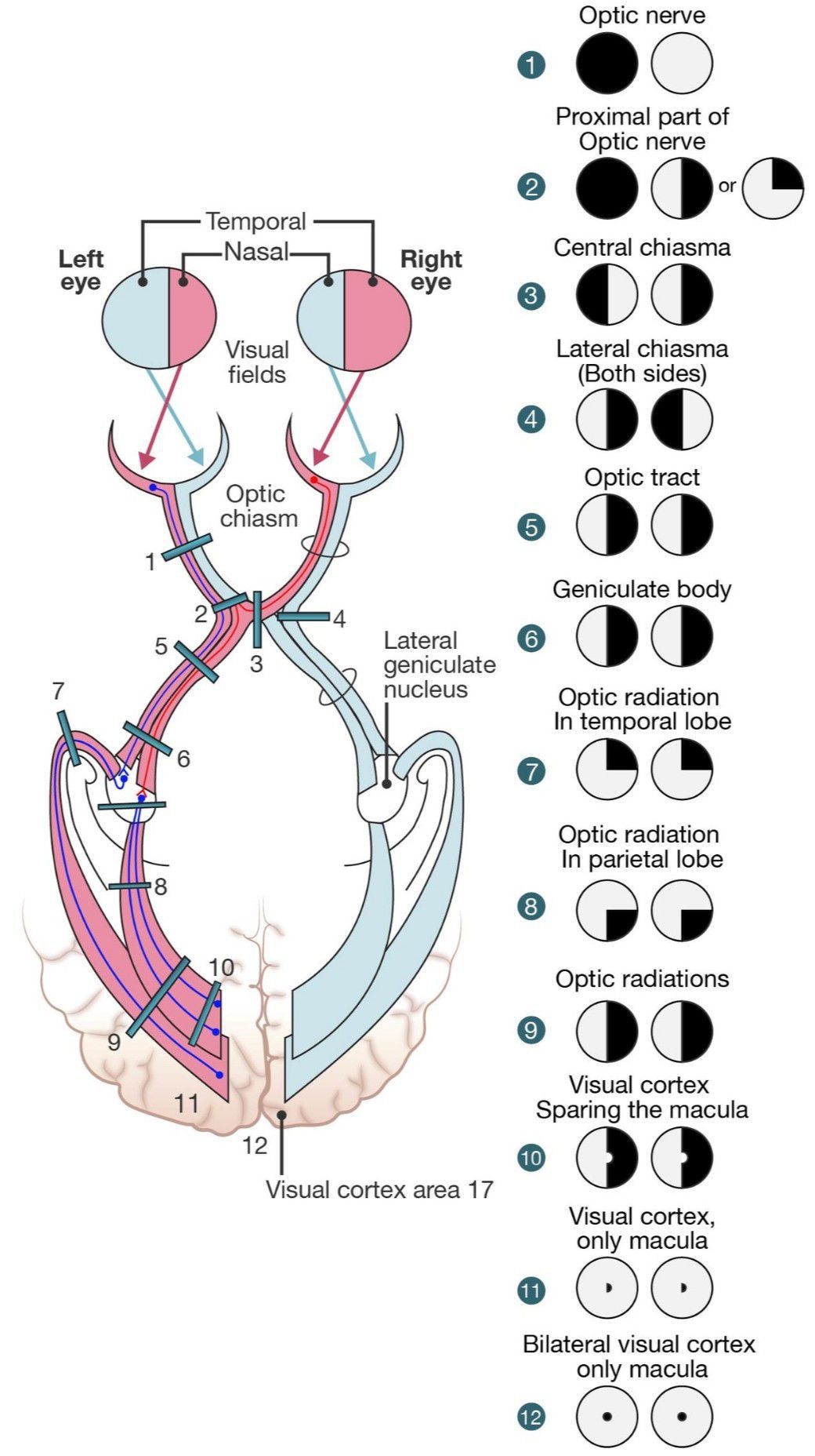 Lesions In Visual Pathway MEDizzy