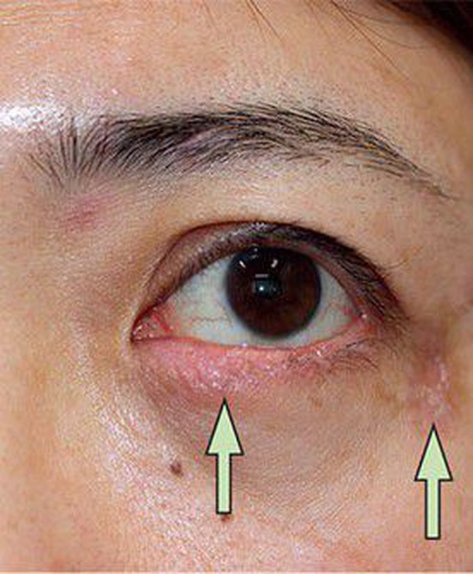 Persistently red and swollen eyelids - MEDizzy