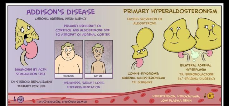 Addisons disease. - MEDizzy