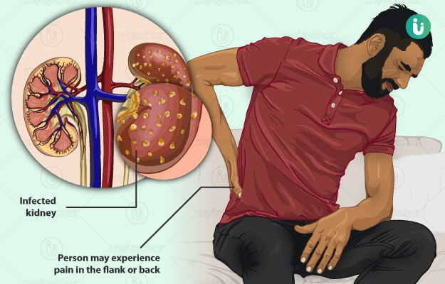 Symptoms of kidney infection - MEDizzy