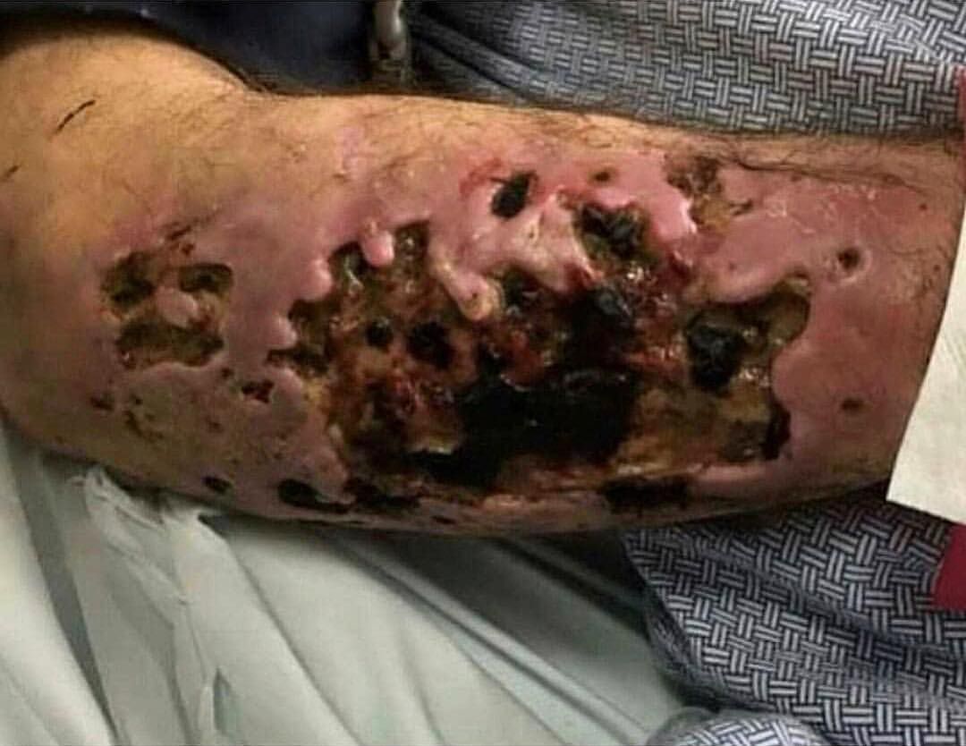 Krokodil Drug Effects How Dangerous Is Tranq, The New Drug Sweeping