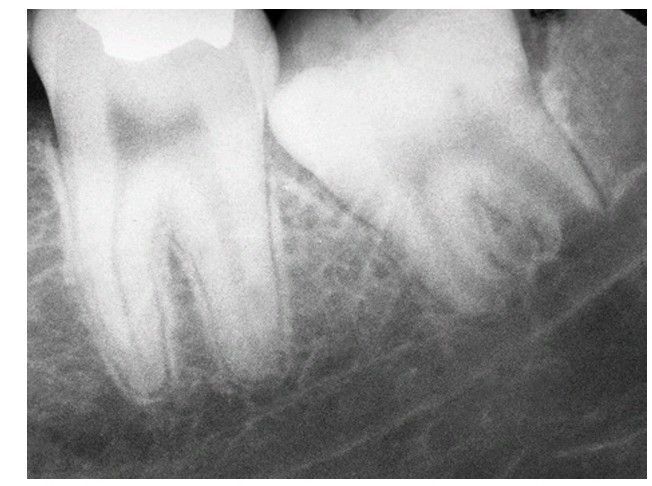 Ideal time to remove impacted tooth - MEDizzy