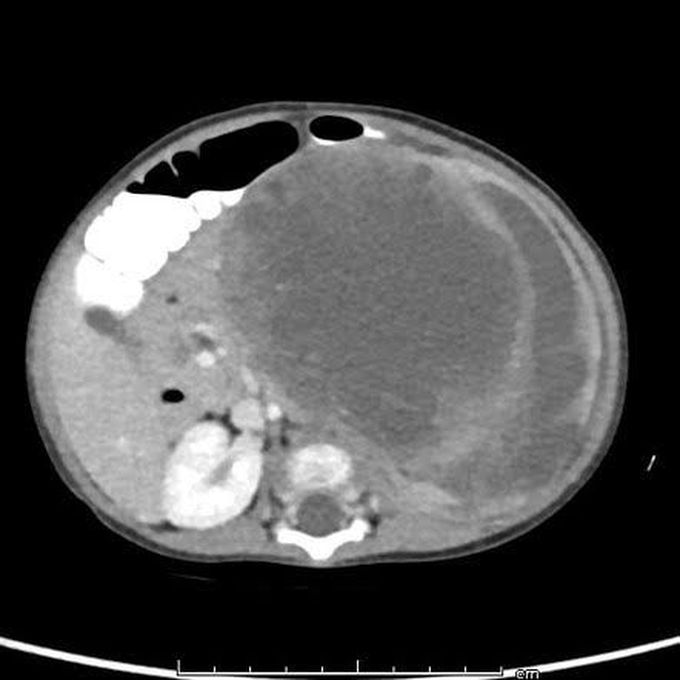 Mesoblastic nephroma - MEDizzy