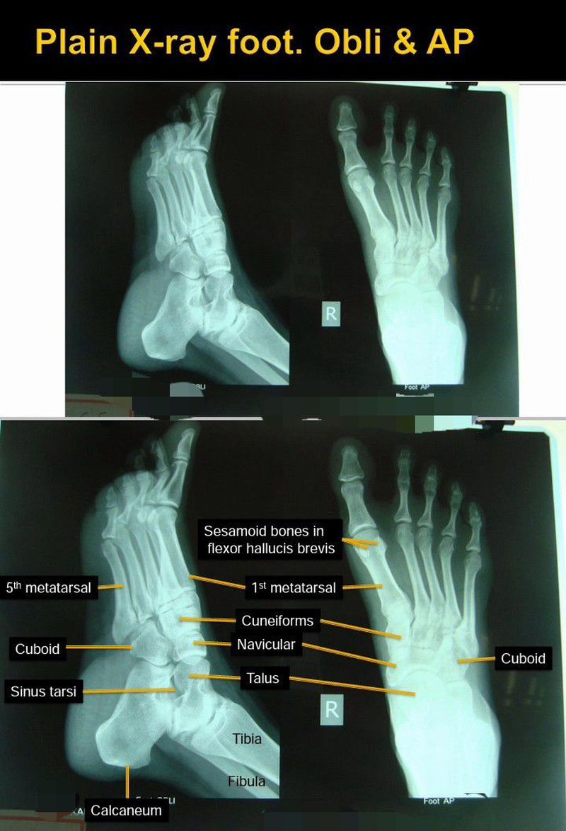 Foot X-ray - MEDizzy
