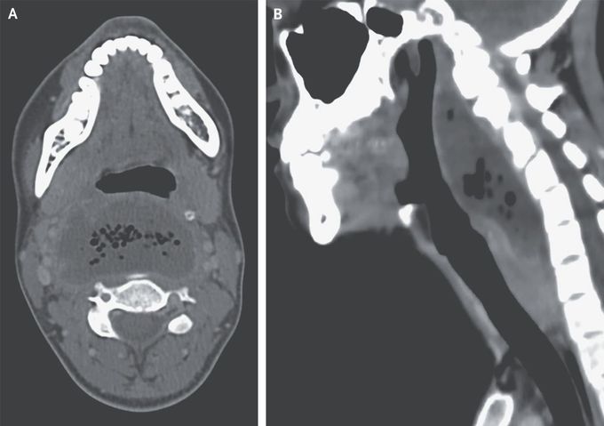 Retropharyngeal Abscess - MEDizzy