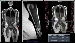 Utilizing the FOV phase properly @ Siemens 3T Skyra WB-MRI - MEDizzy