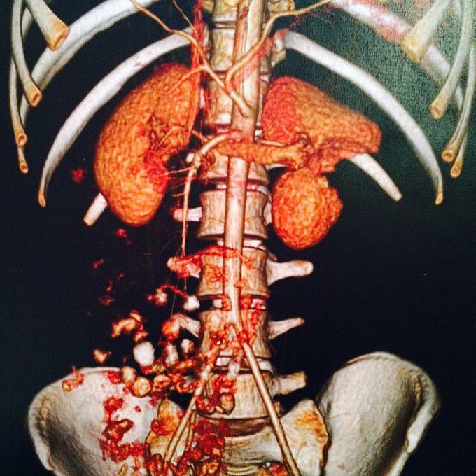 Tearing kidney..stab wound - MEDizzy