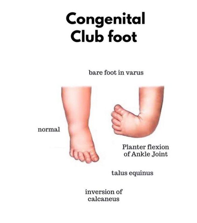 Club foot - MEDizzy