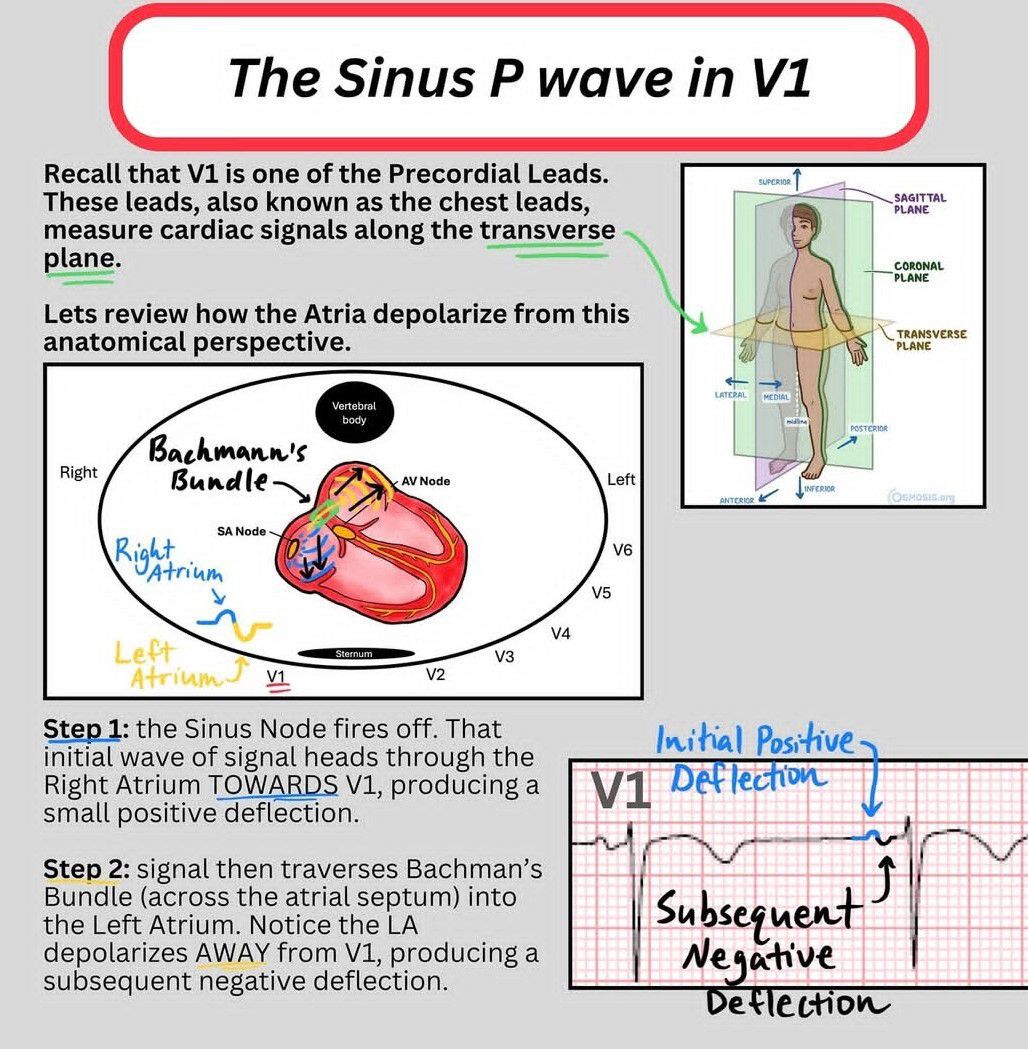 Sinus P Wave in V1 - MEDizzy