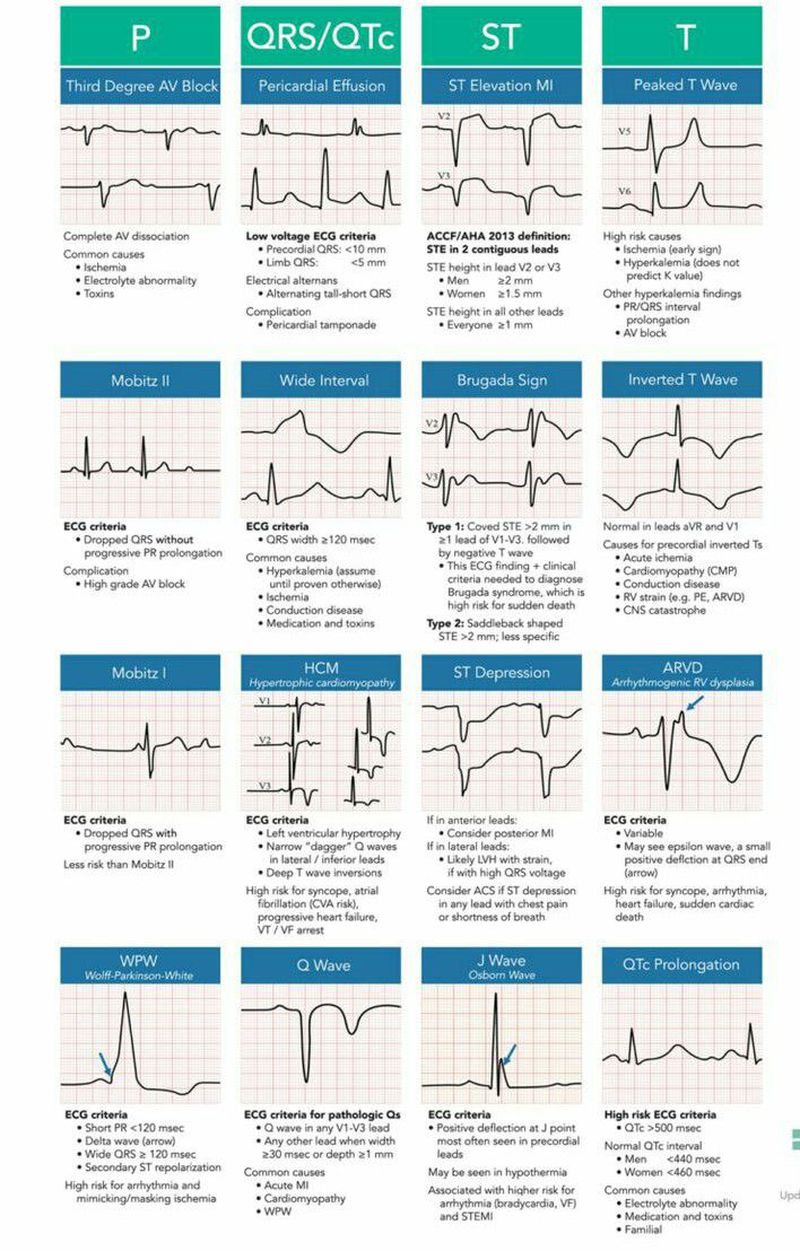 ECG findings - MEDizzy