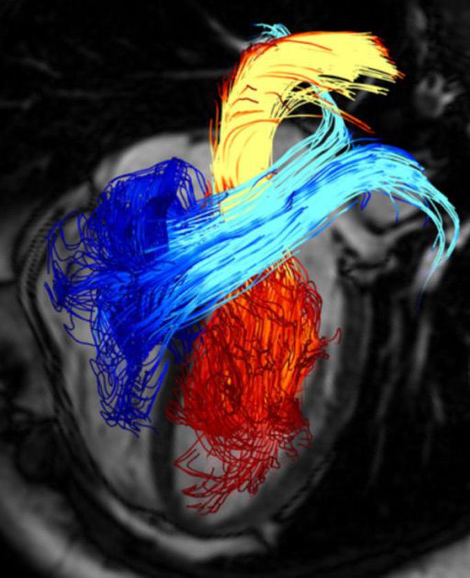 Comprehensive 4D velocity mapping of the heart and great - MEDizzy