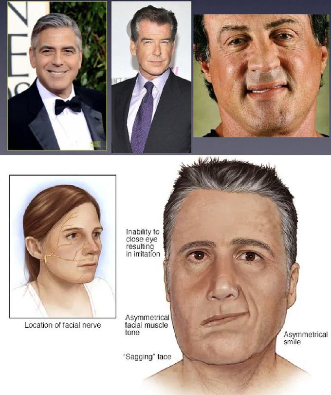 Bell s Palsy MEDizzy