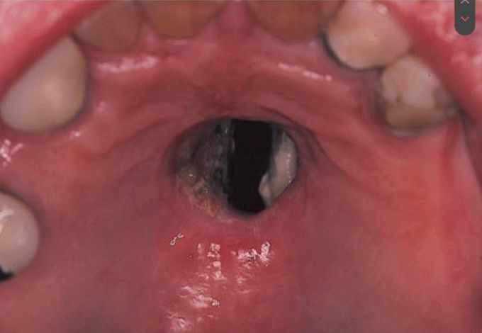 Palatal lesion of wegener's granulomatosis - MEDizzy