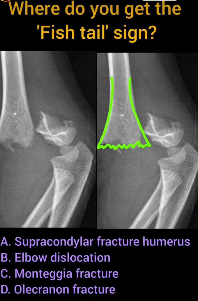 Fish Tail Sign - MEDizzy