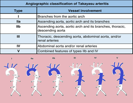Classification of Takayasu Arteritis - MEDizzy