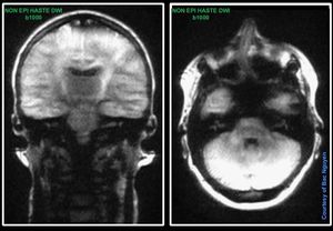 NON EPI HASTE DWI @ Siemens 3T Prisma You missing this - MEDizzy