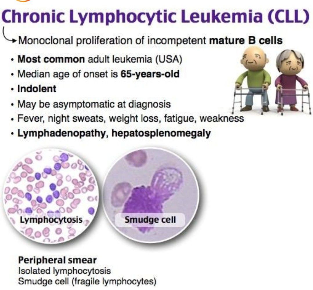 Chronic Lymphocytic Leukemia Smudge Cells