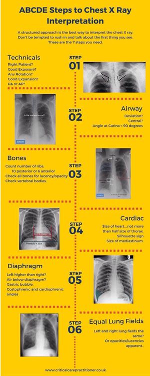 Easy steps to Chest X Ray Interpretation - MEDizzy