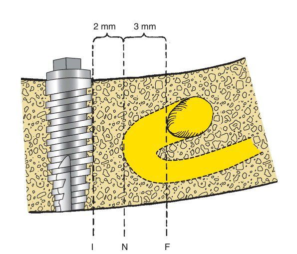 Implant planning - MEDizzy