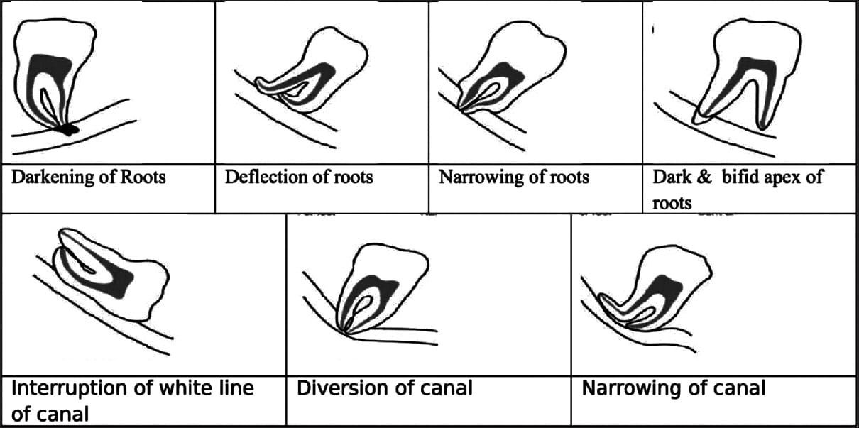 IAN Canal and Mandibular Molar - MEDizzy