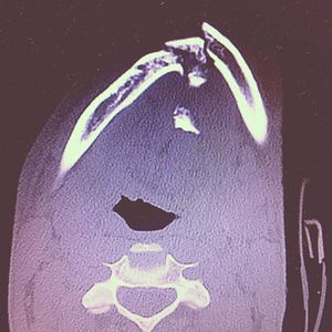 When the jaw is broken into 5 pieces and dislocated at the - MEDizzy